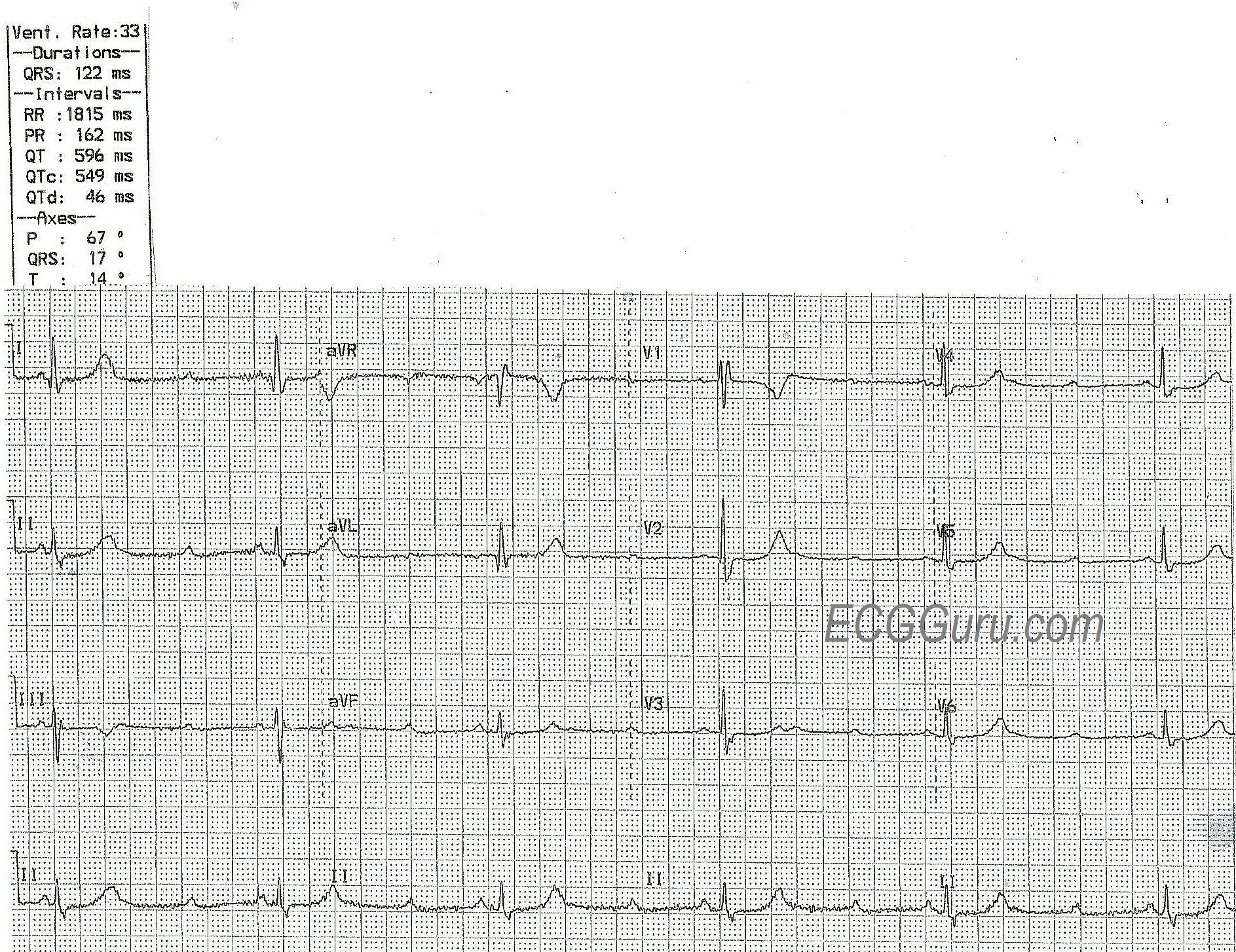 Second-degree AV Block, Type II? | ECG Guru - Instructor Resources Second-degree AV Block, Type II? | ECG Guru - Instructor Resources